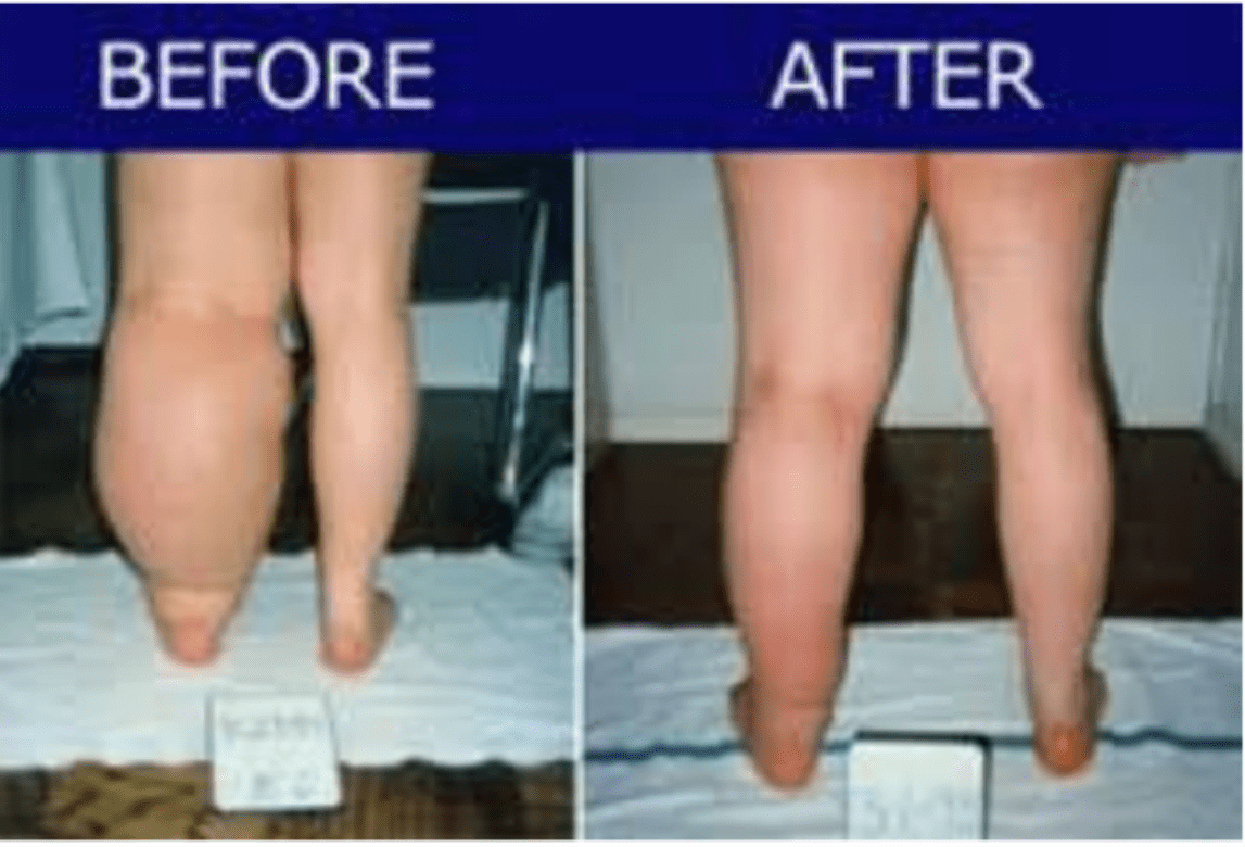 The Complete Guide to Intermittent Compression Devices for 2023 ...